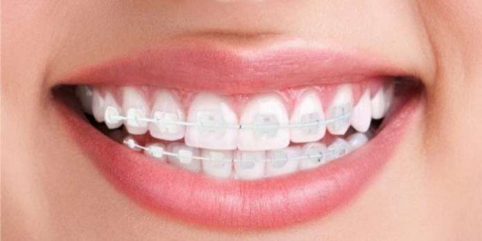 10 Benefits of Clear Bracket Braces - Smile Bright